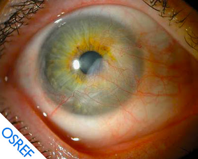 Corneal Pannus: A Photographic Review - Eyedolatry