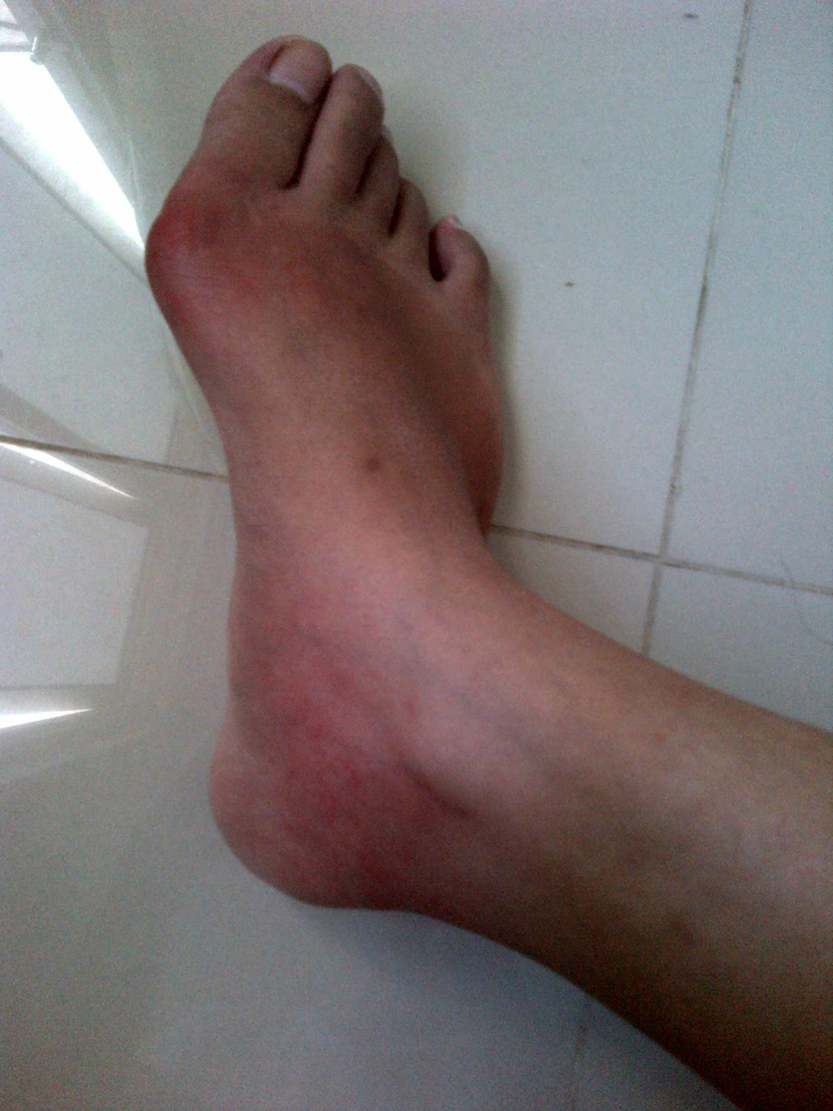 doctoringmyself: Gout dan Asam Urat