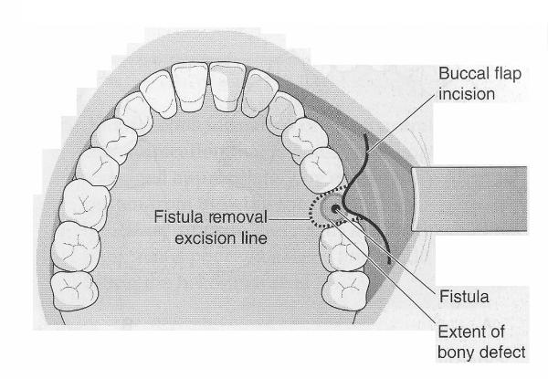 WizDent: Buccal advancement flap
