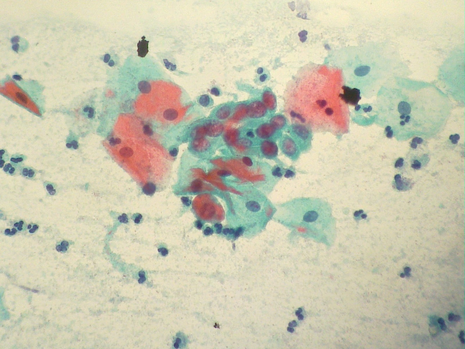 The Cell Hunter Society: Case No. PAP4318-11 HSIL