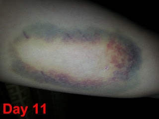 My experience with the birth control Implanon