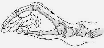 Planète Kiné: La fracture de Pouteau-Colles