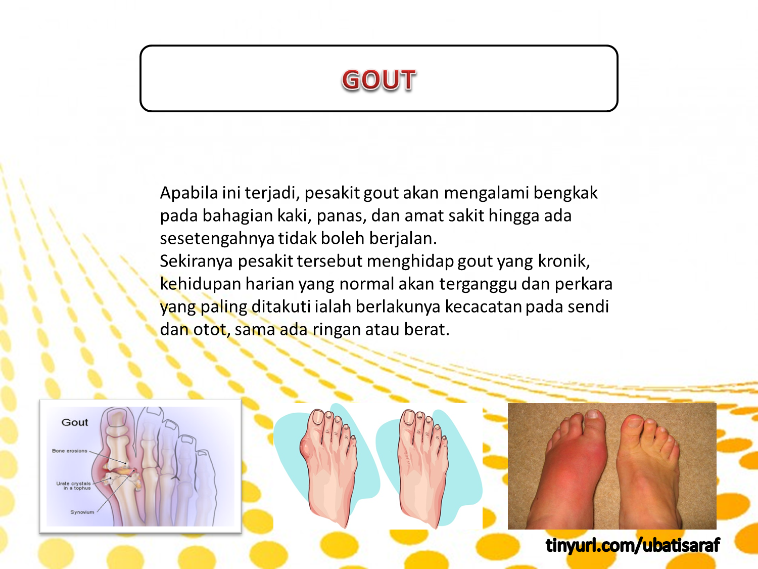 Mewah Ilmu: GOUT: PUNCA DAN PENAWARNYA
