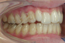 Experiencia Invisalign: ¿Por qué hay que llevar anclajes?