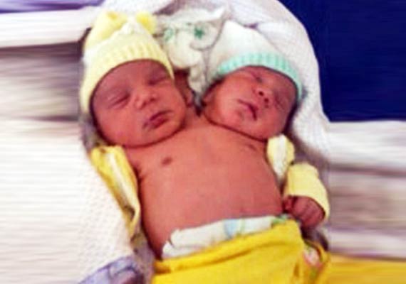 Baby born with two heads in Brazil