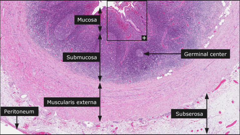 MoyinAdesanyaBiol 3500: The Human Appendix: My Favorite Organ: The ...