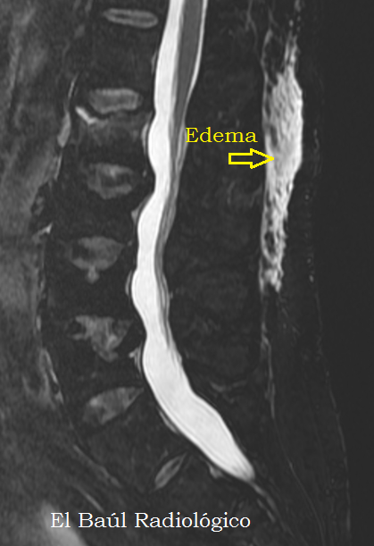 El Baúl Radiológico: LINFEDEMA SUBCUTÁNEO LUMBOSACRO (Lumbosacral ...