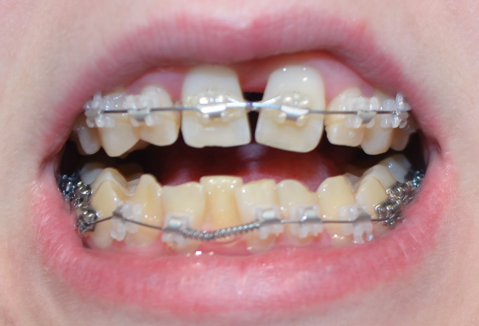 Amy's SARPE Adventure: Owwwww :( Bottom braces on...