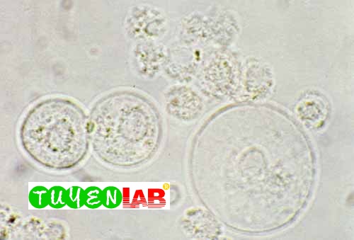 Transitional Epithelial Cells In Urine