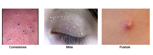 Extractions: comedones, milia, and pustules, oh my! | adair™ skin care