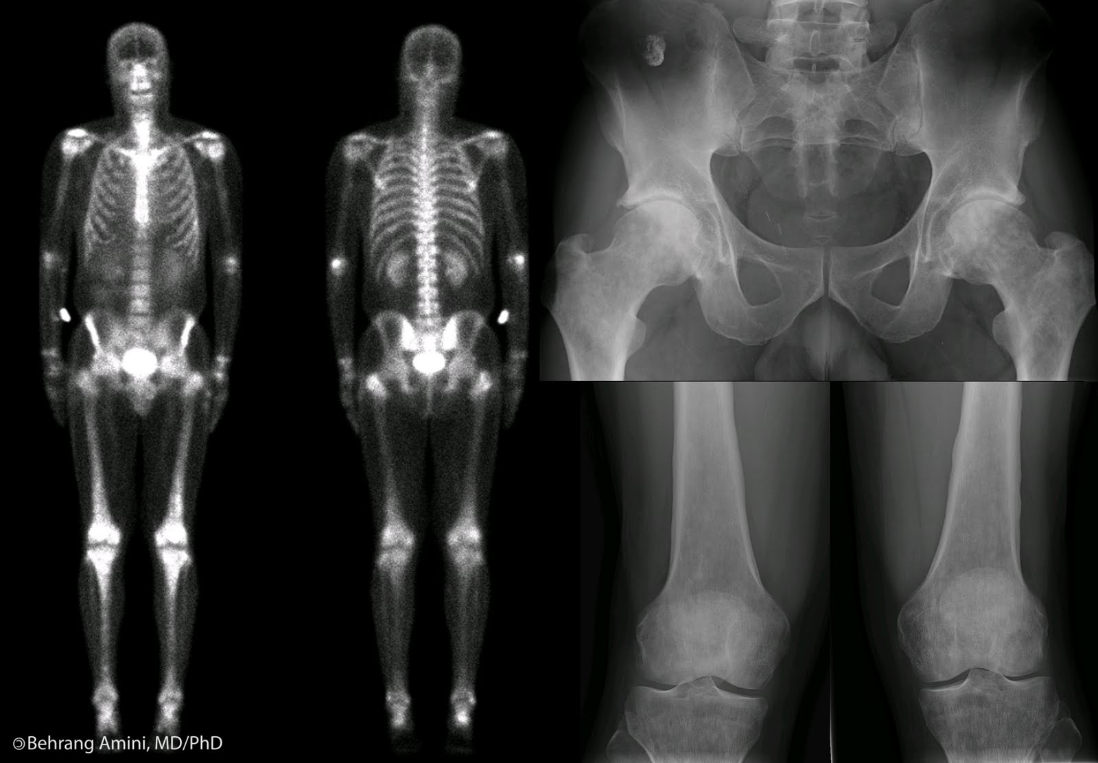 Roentgen Ray Reader: Erdheim-Chester Disease