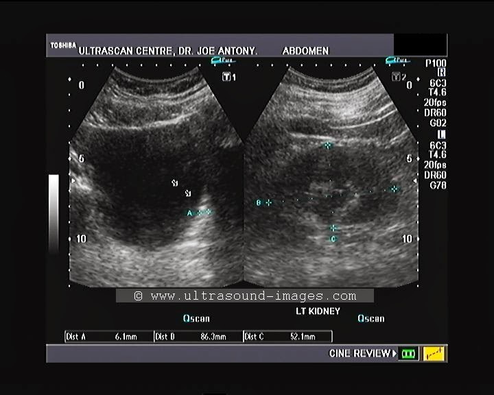 Hidden VUJ calculus ~ Ultrasound Cases Info