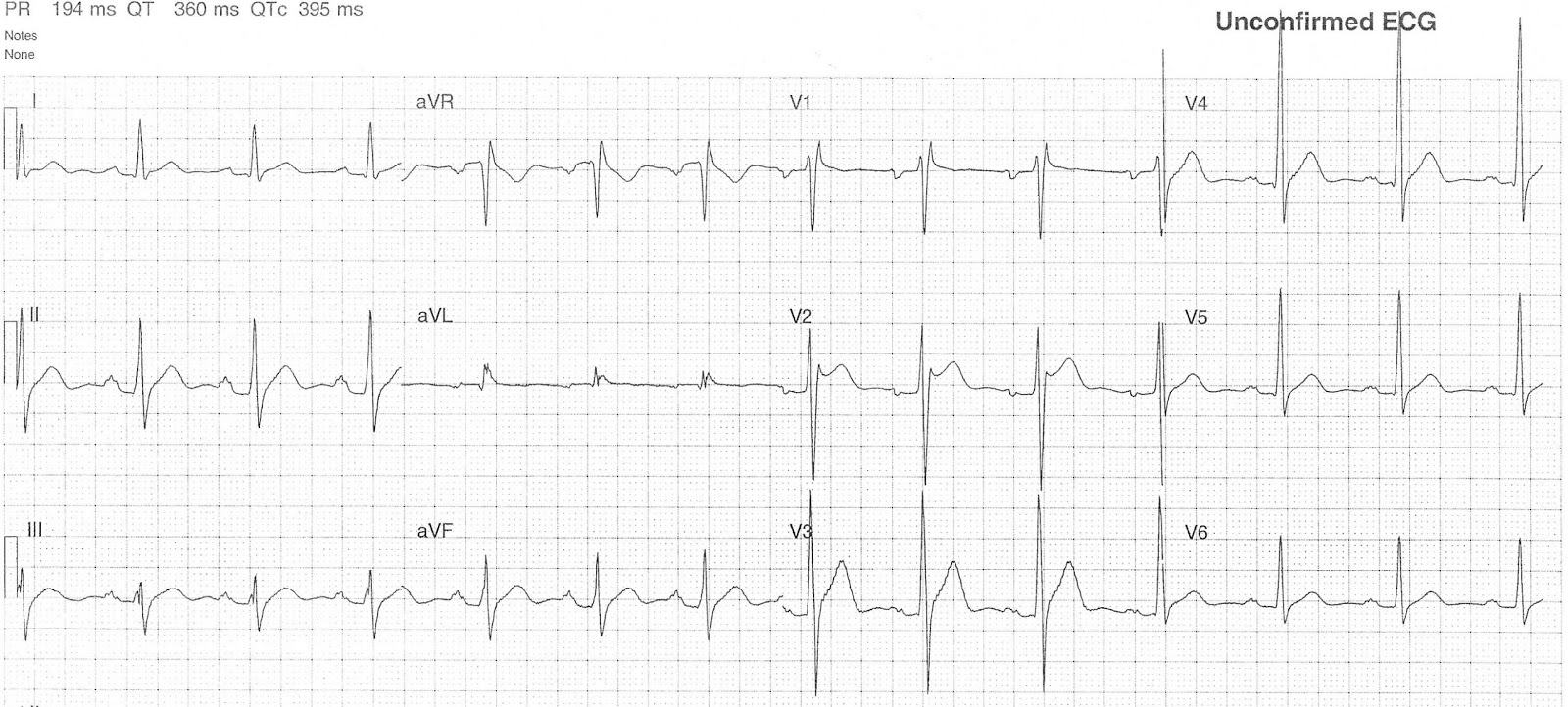 ECG of the Week: ECG of the Week - 22nd February 2016 - Interpretation