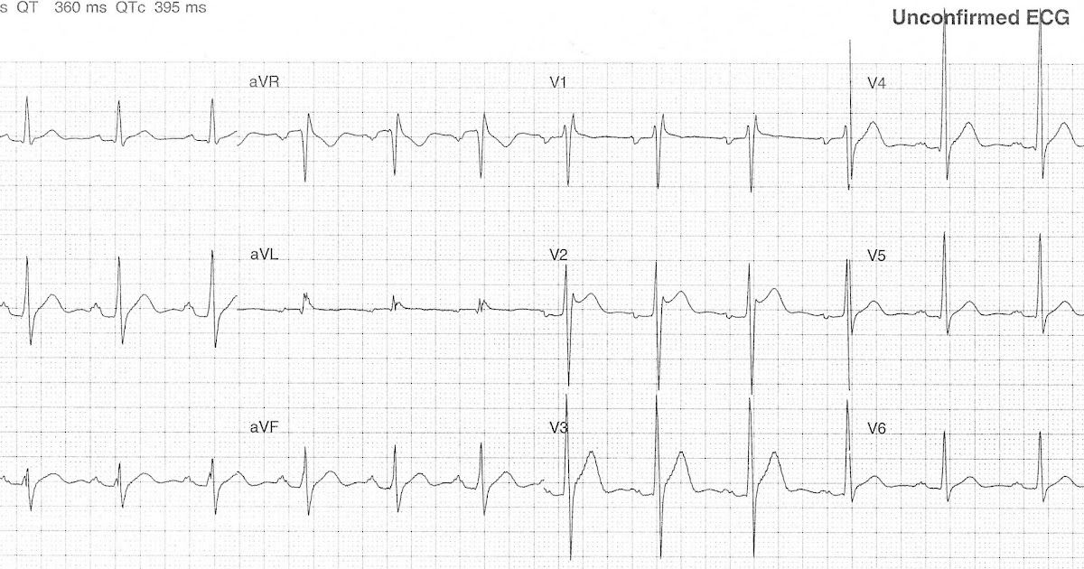 ECG of the Week: ECG of the Week - 22nd February 2016 - Interpretation