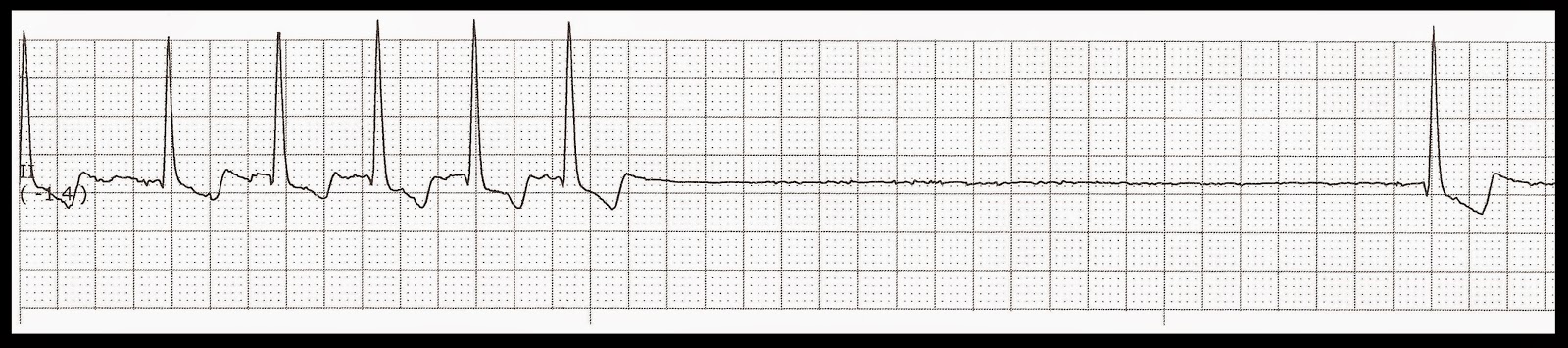 Float Nurse: Practice EKG Strips 344
