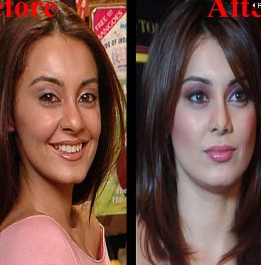 Bollywood Celebrities Who Use Botox, Liposuction And Plastic Surgery ...