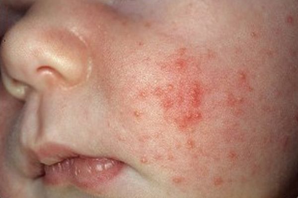 Cara Mengatasi Ruam Kulit | Perawat Ilmiah