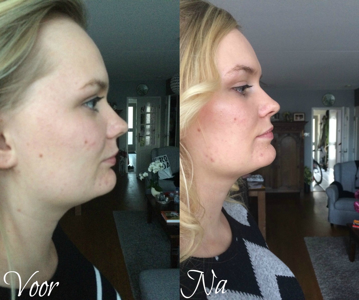 Kaakoperatie (Kaakosteotomie): 2016