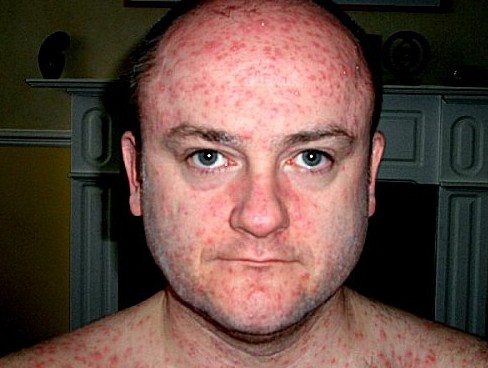 Healthy and Beauty Tips: Chickenpox Treatment | Chickenpox Relief