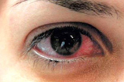 Saúde! Seu Sucesso.: As Diversas Causas do Olho Vermelho