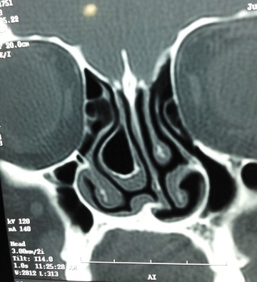 ENT Surgeon's blog: Giant Concha bullosa