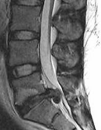Medical Treatment Pictures-for Better Understanding: Discectomy Surgery ...