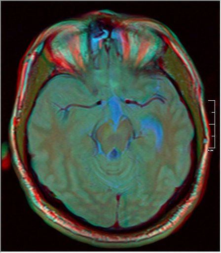 Nevit's blog: Motion atrifacts, Color Brain MRI