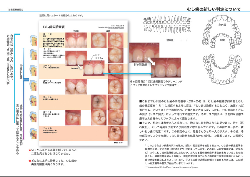 ICDAS-JHCDA: 日本ヘルスケア歯科学会のICDASに関しての取り組み