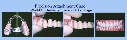 :: World Of Dentistry ::: Precision Attachment