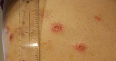 Psychology of Medicine: Ulcer (dermatology)