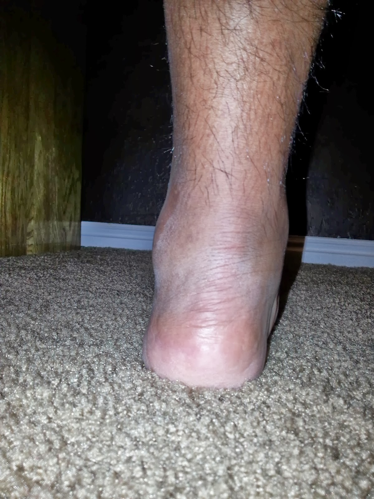 Peroneal Tendon Surgery Recovery: Ankle Time Line (updated for week 10/11)
