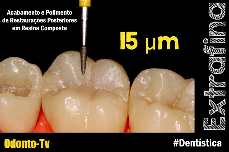 RESINA COMPOSTA: Acabamento e Polimento de Restaurações Posteriores