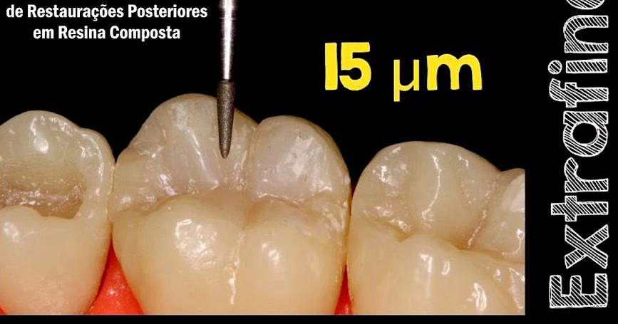 RESINA COMPOSTA: Acabamento e Polimento de Restaurações Posteriores ...