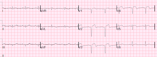 Dr. Smith's ECG Blog: Anterior STEMI and multiform PVCs with Narrow ...