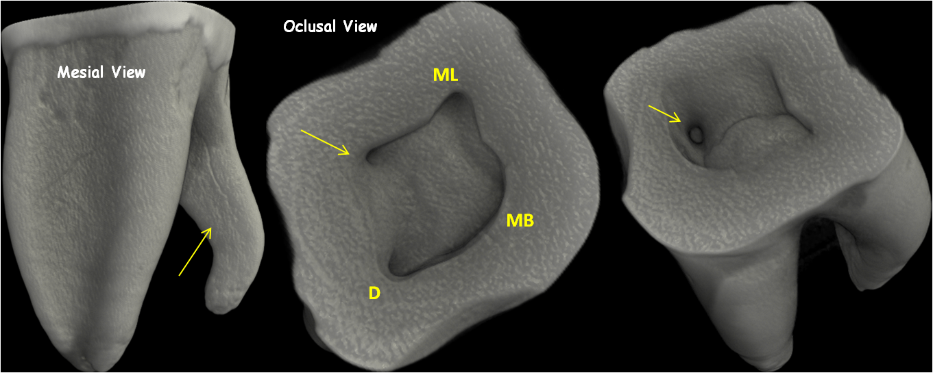 The Root Canal Anatomy Project: Mandibular Second Molar: Radix Entomolaris