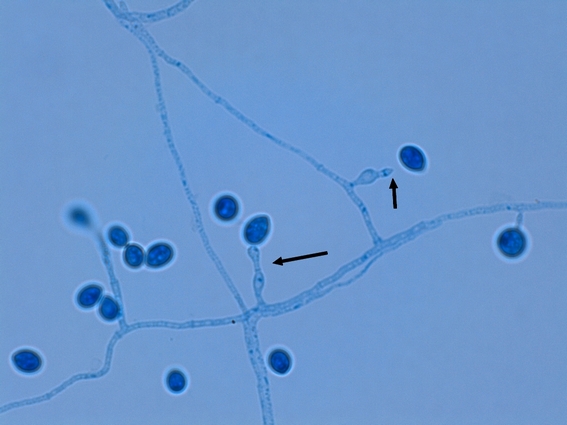 Fun With Microbiology (What's Buggin' You?): Scedosporium prolificans