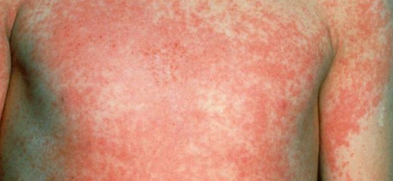 AMG: Boli infecto-contagioase C4 Scarlatina