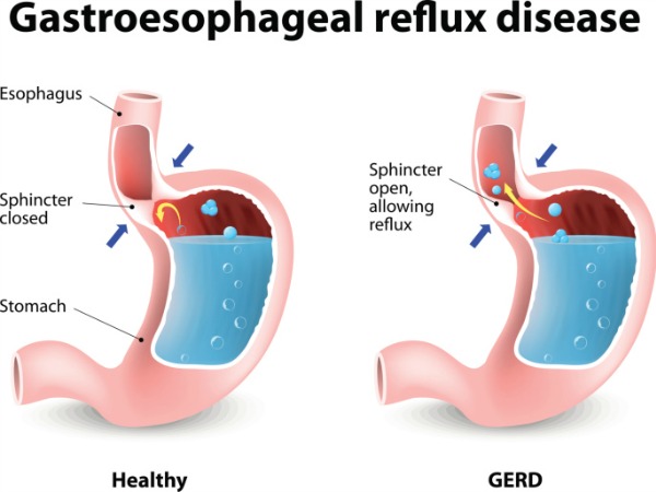 Prepare for Medical Exams : Gastroesophageal Reflux Disease