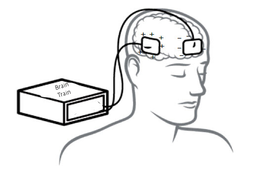 Insight, a growth project driven by tDCS: The Clinical Uses of tDCS ...