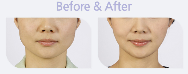 Eyelid Surgery Legend Dr. Kim Byung Gun: [BK Plastic Surgery Hospital ...