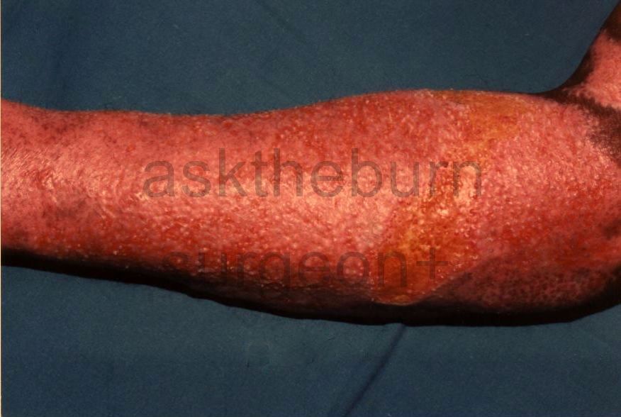 Ask The Burn Surgeon +For Free+: BURN PICTURES AND BURN VIDEOS.