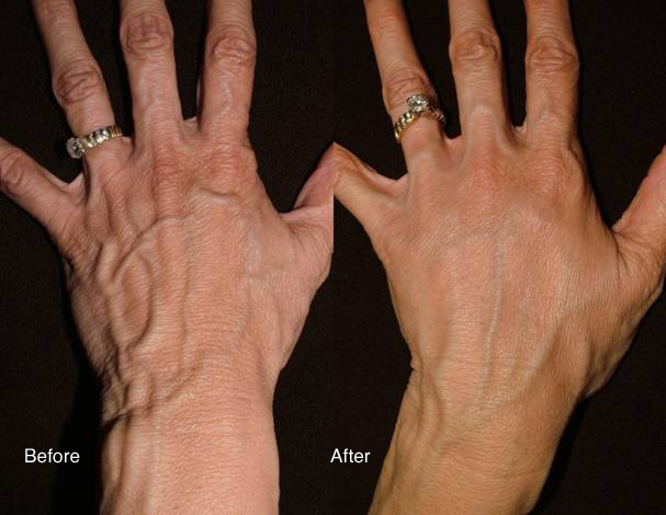 Sarah Jessica Parker Before And After Hands