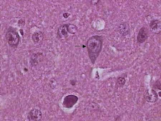 Bioquímica do Alzheimer: A Desorientação Topográfica na Doença de Alzheimer