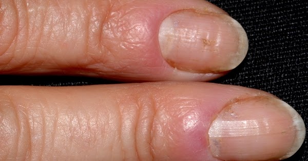 Perionixis u onixis tratamiento | Salud y Cuidados