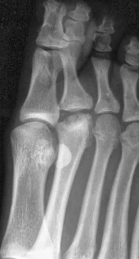 ABC Radiology Blog: Avascular necrosis (Osteonecrosis)