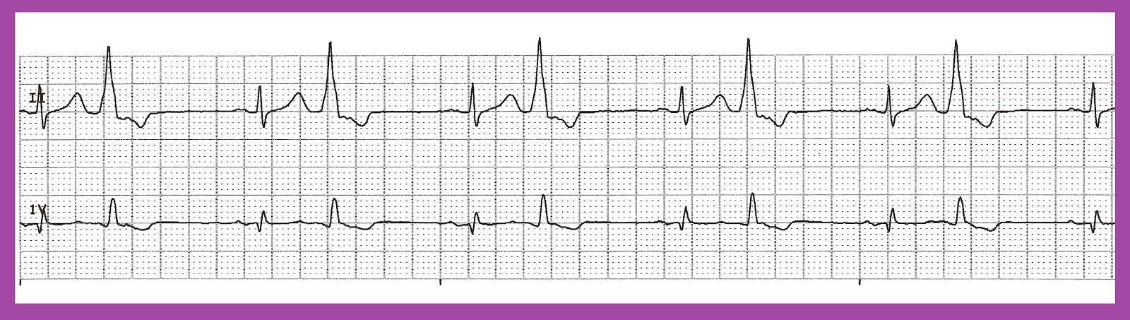 Practice EKG Strips 325