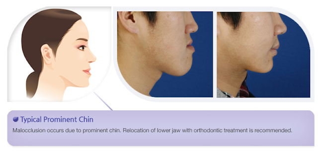 BK Plastic Surgery: [BK Plastic Surgery] Protruding Chin Correction