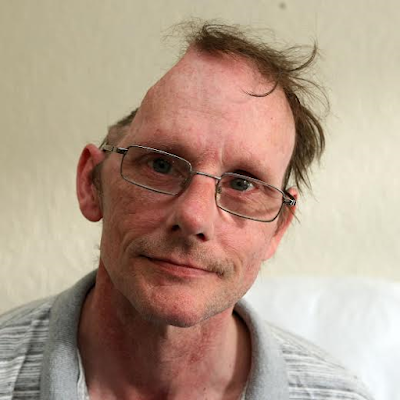 Man with half-head complains after his ?195 a week benefits is slashed ...