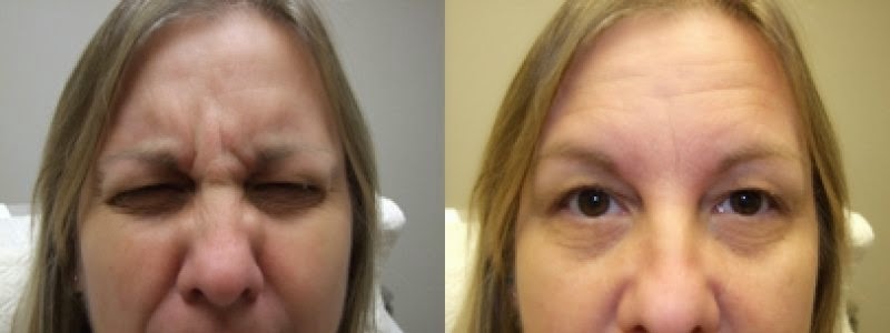 Minimizing Wrinkles And Lifting Facial Skin With Face Workouts: Face ...