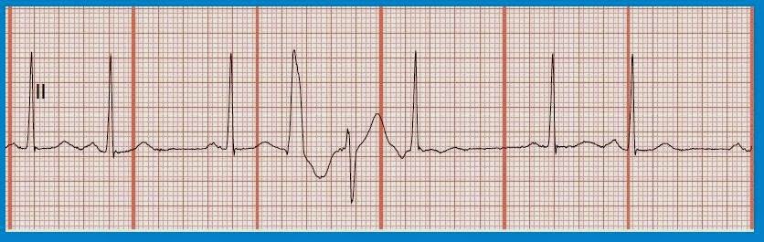 Practice Rhythm Strips 295